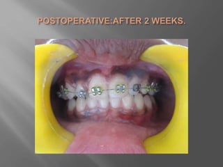 Orthodontic correction of rotated tooth | PPTX | Dental Health ...
