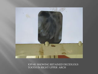 Orthodontic correction of rotated tooth | PPTX | Dental Health ...