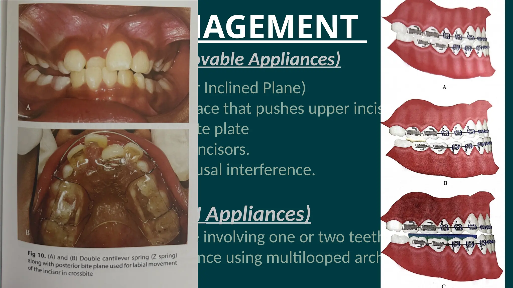 Cross bite management orthodontic CROSSBITE.pptx