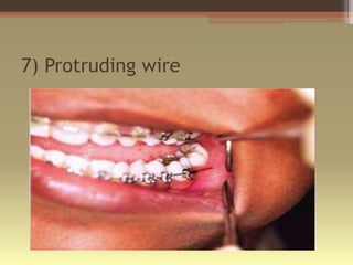 Orthodontic emergencies | PPTX
