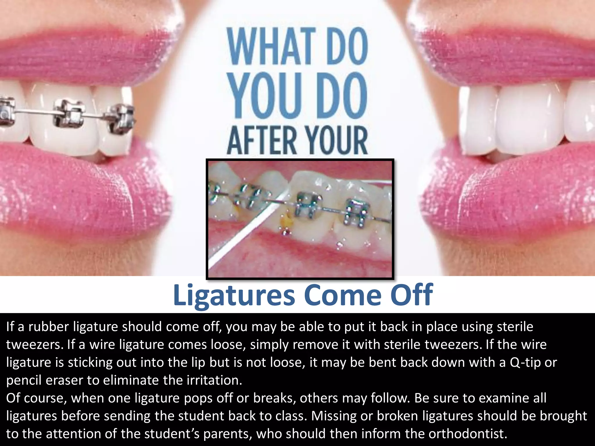 Orthodontic emergencies at hiremath orthodontics | PDF