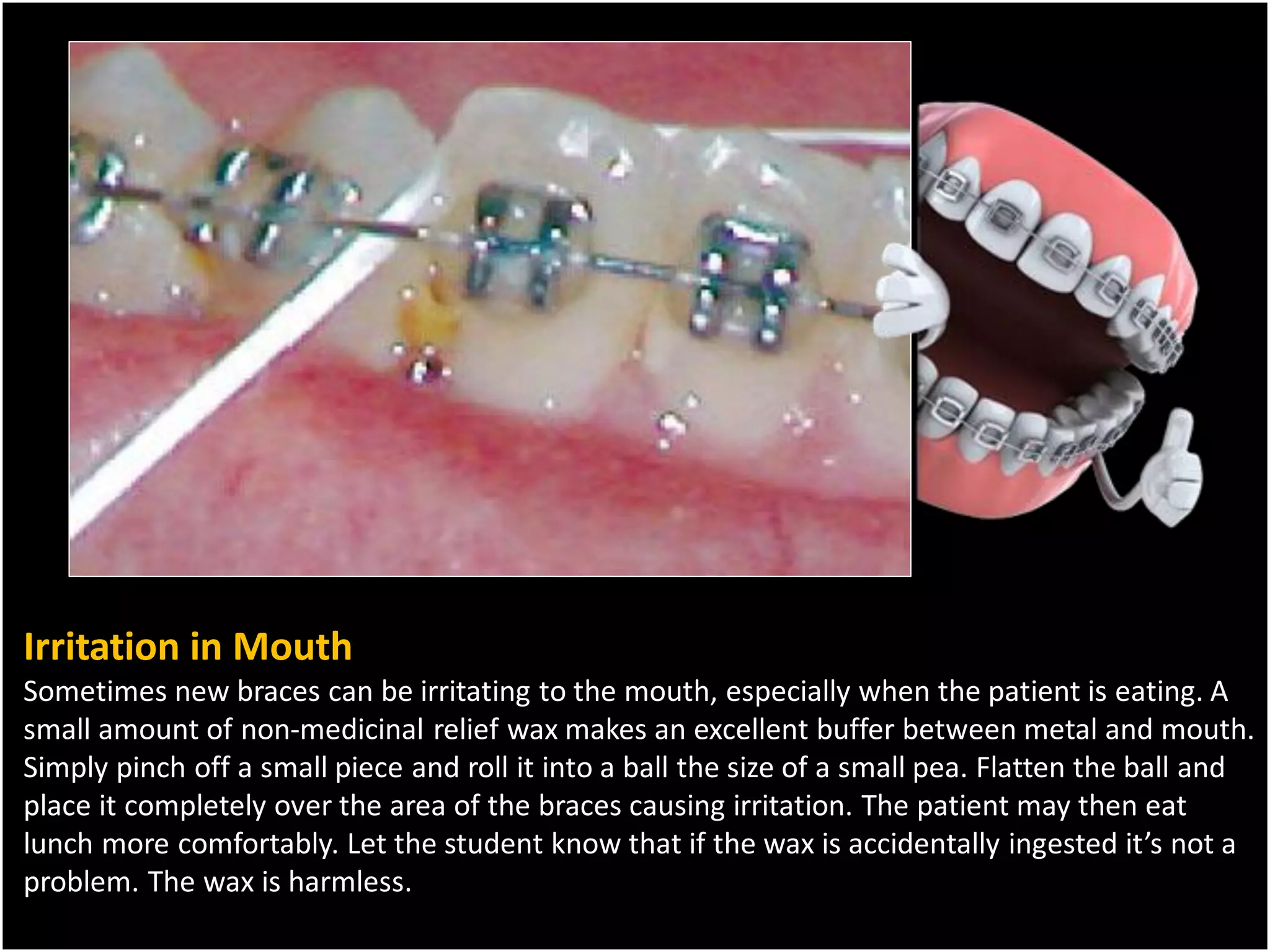 Orthodontic emergencies at hiremath orthodontics | PDF