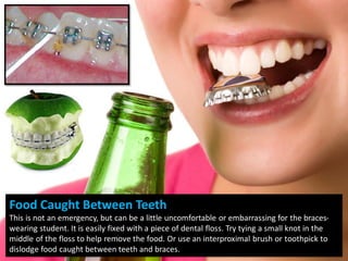 Orthodontic emergencies at hiremath orthodontics | PDF