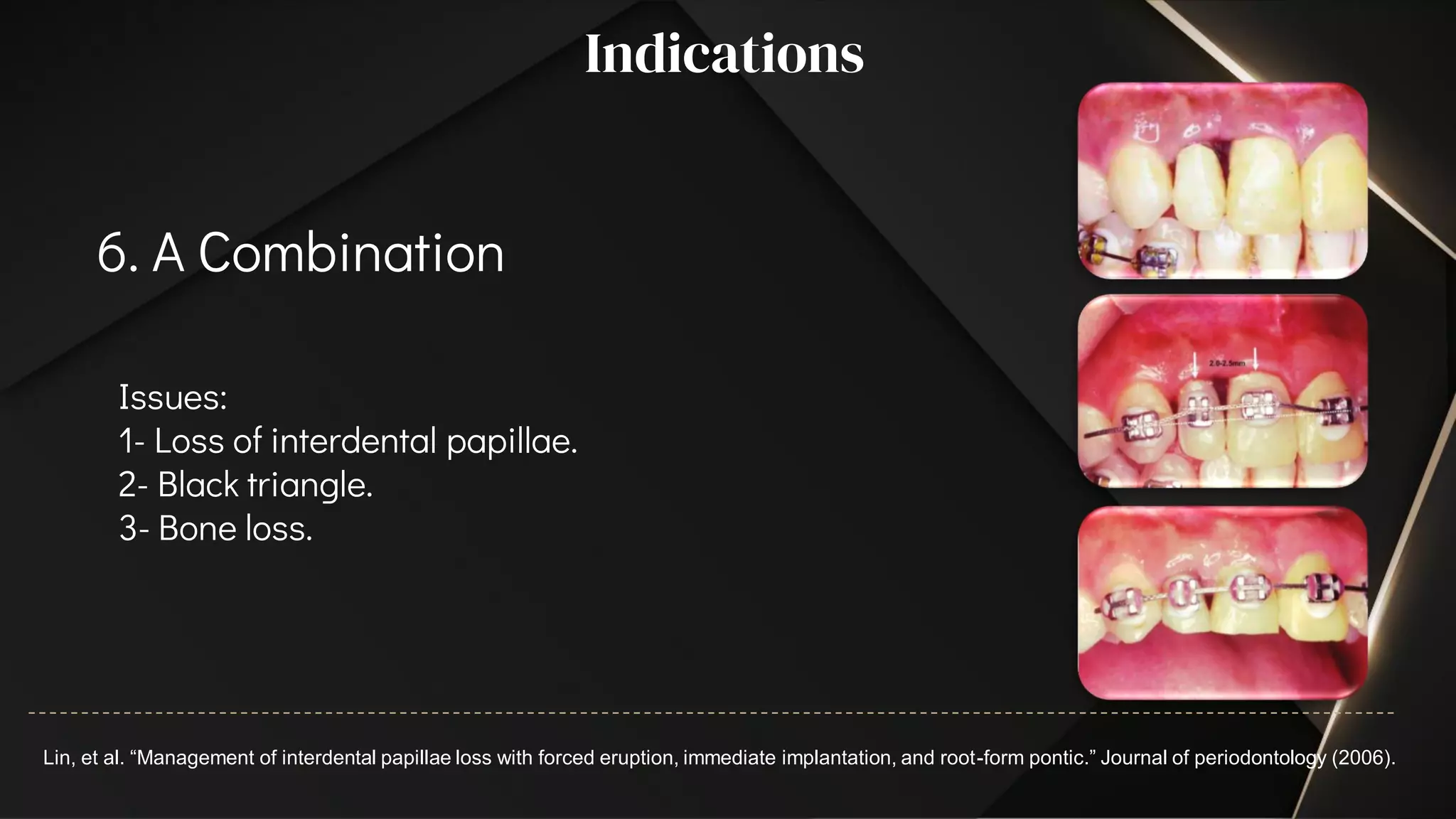 Orthodontic Extrusion | PDF