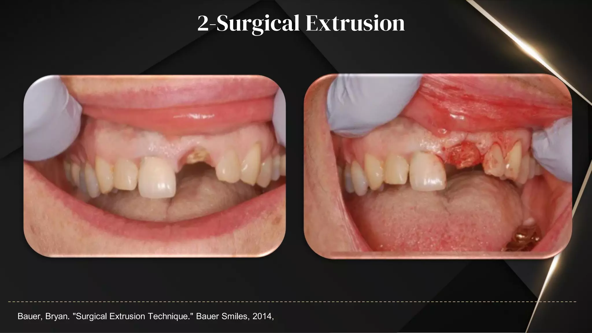 Orthodontic Extrusion | PDF