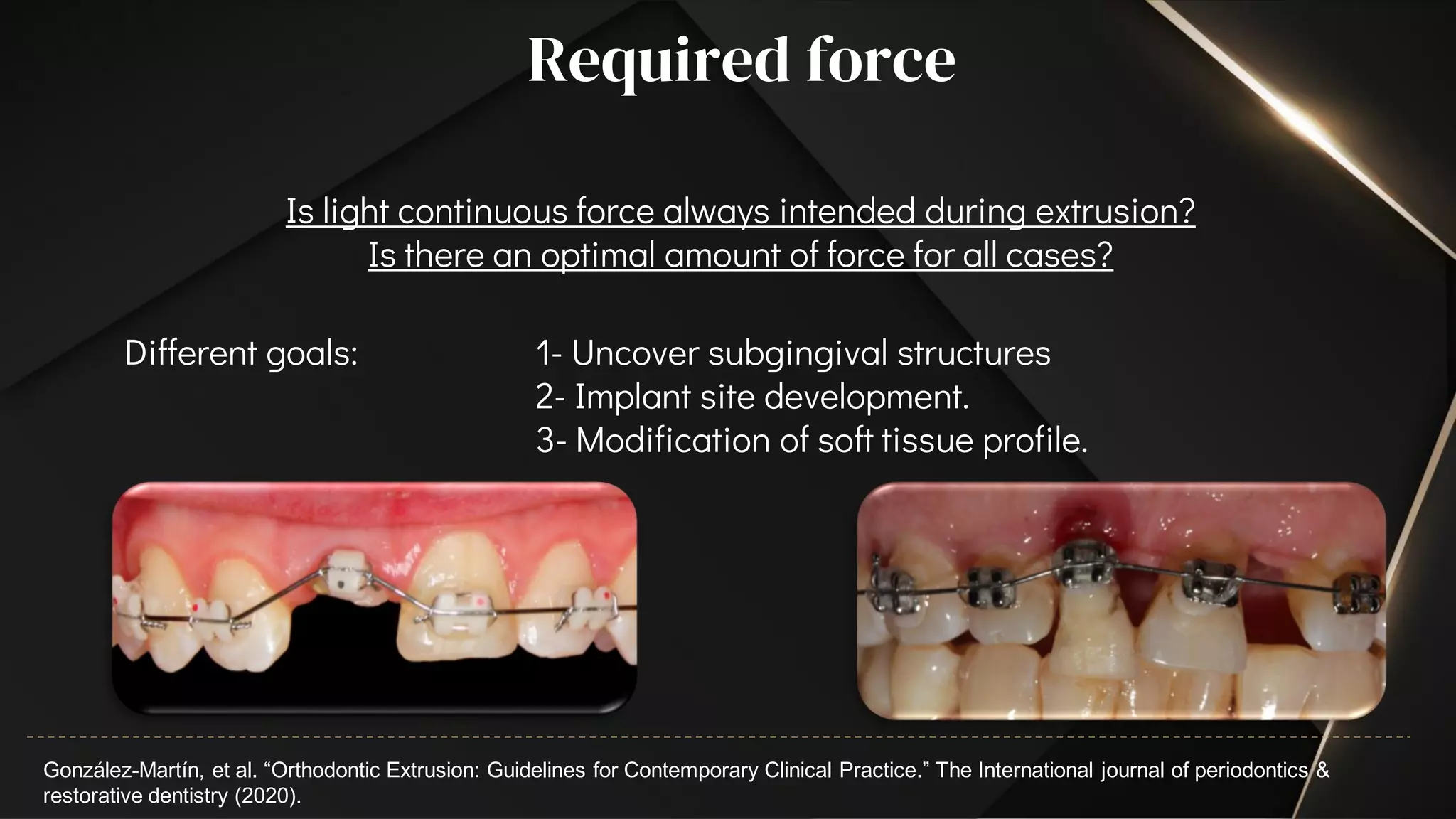 Orthodontic Extrusion | PDF
