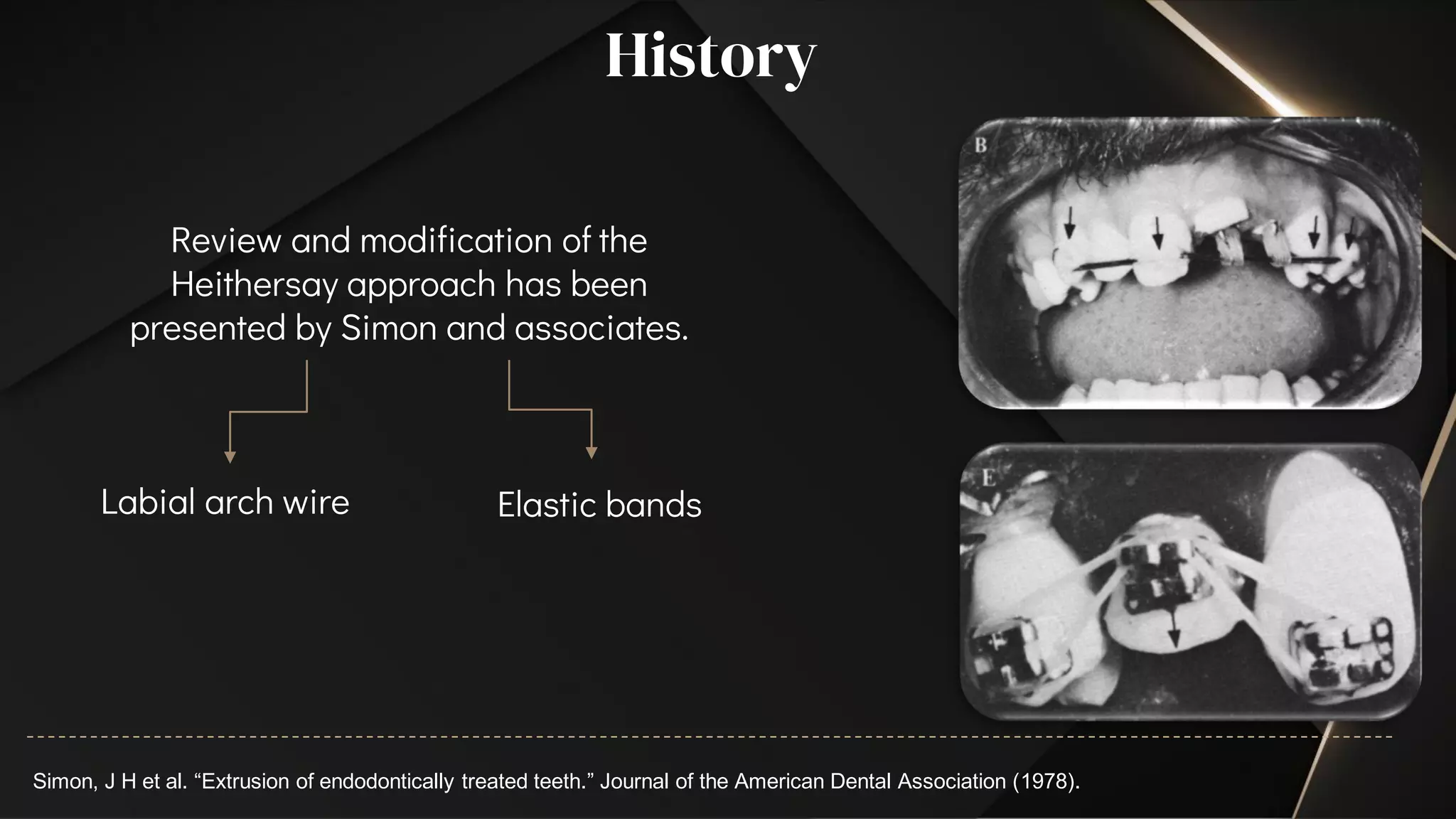 Orthodontic Extrusion | PDF