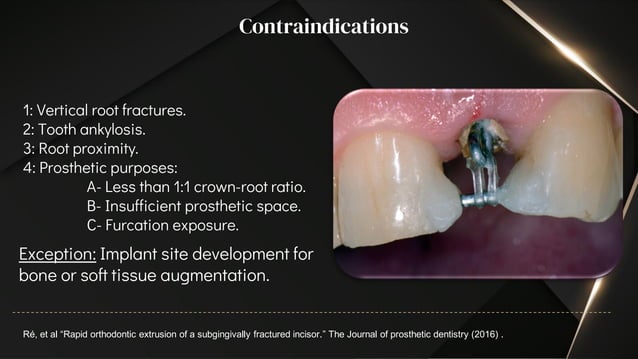 Orthodontic Extrusion | PDF