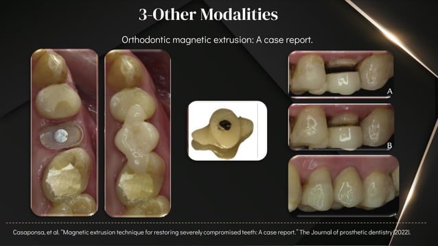 Orthodontic Extrusion | PDF