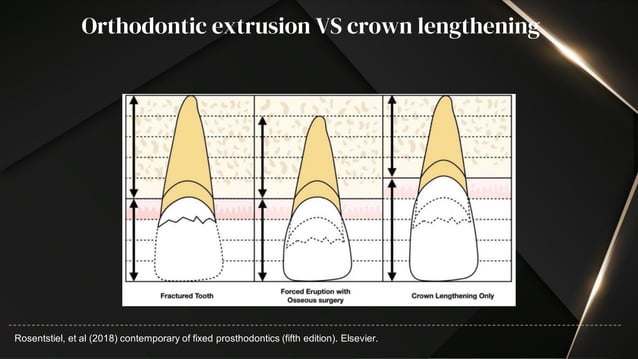 Orthodontic Extrusion | PDF