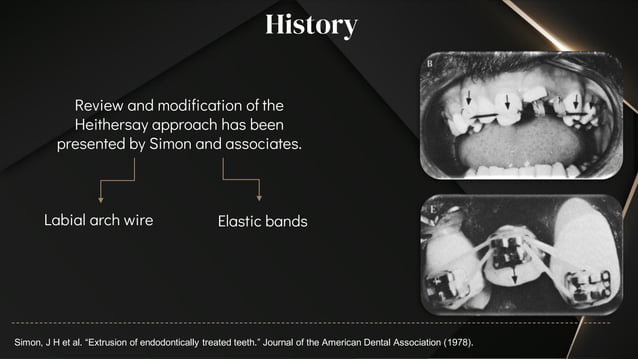 Orthodontic Extrusion | PDF