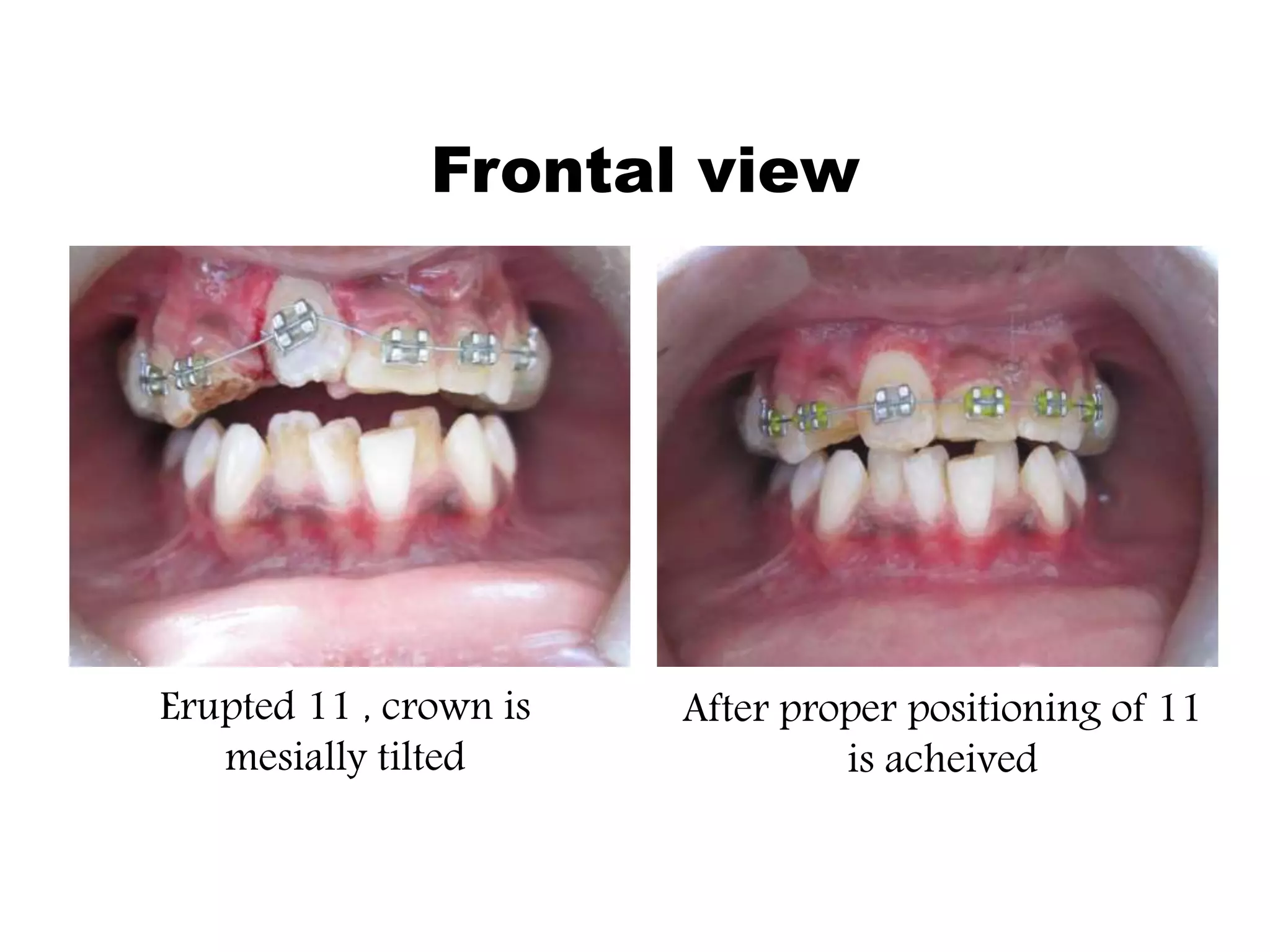 Orthodontic extrusion 2 | PPTX