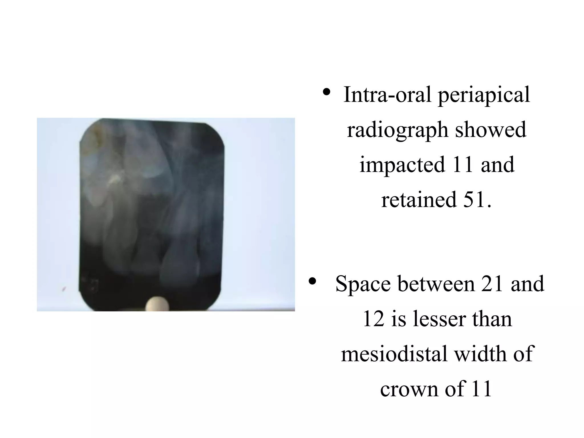 Orthodontic extrusion 2 | PPTX