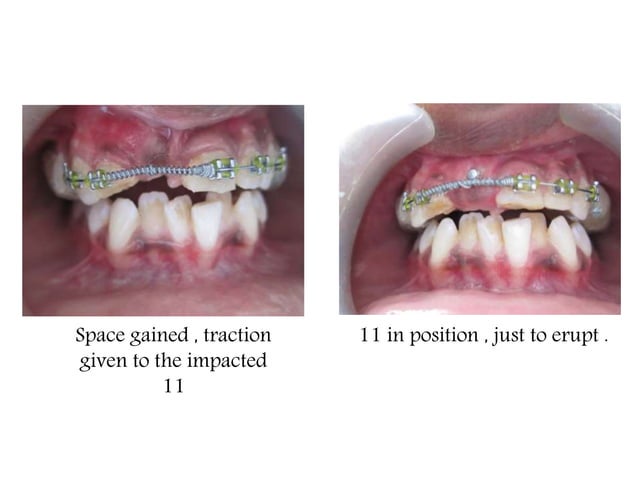 Orthodontic extrusion 2 | PPTX