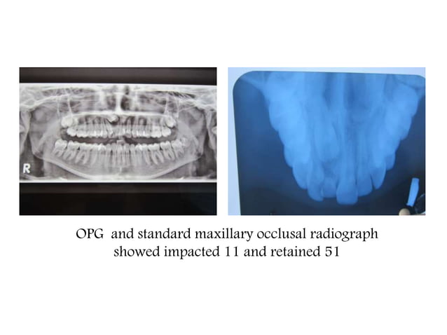 Orthodontic extrusion 2 | PPTX