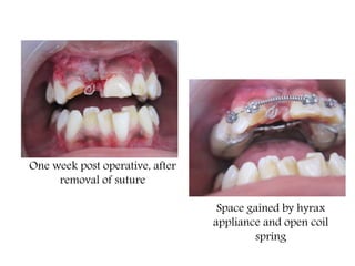 Orthodontic extrusion 2 | PPTX