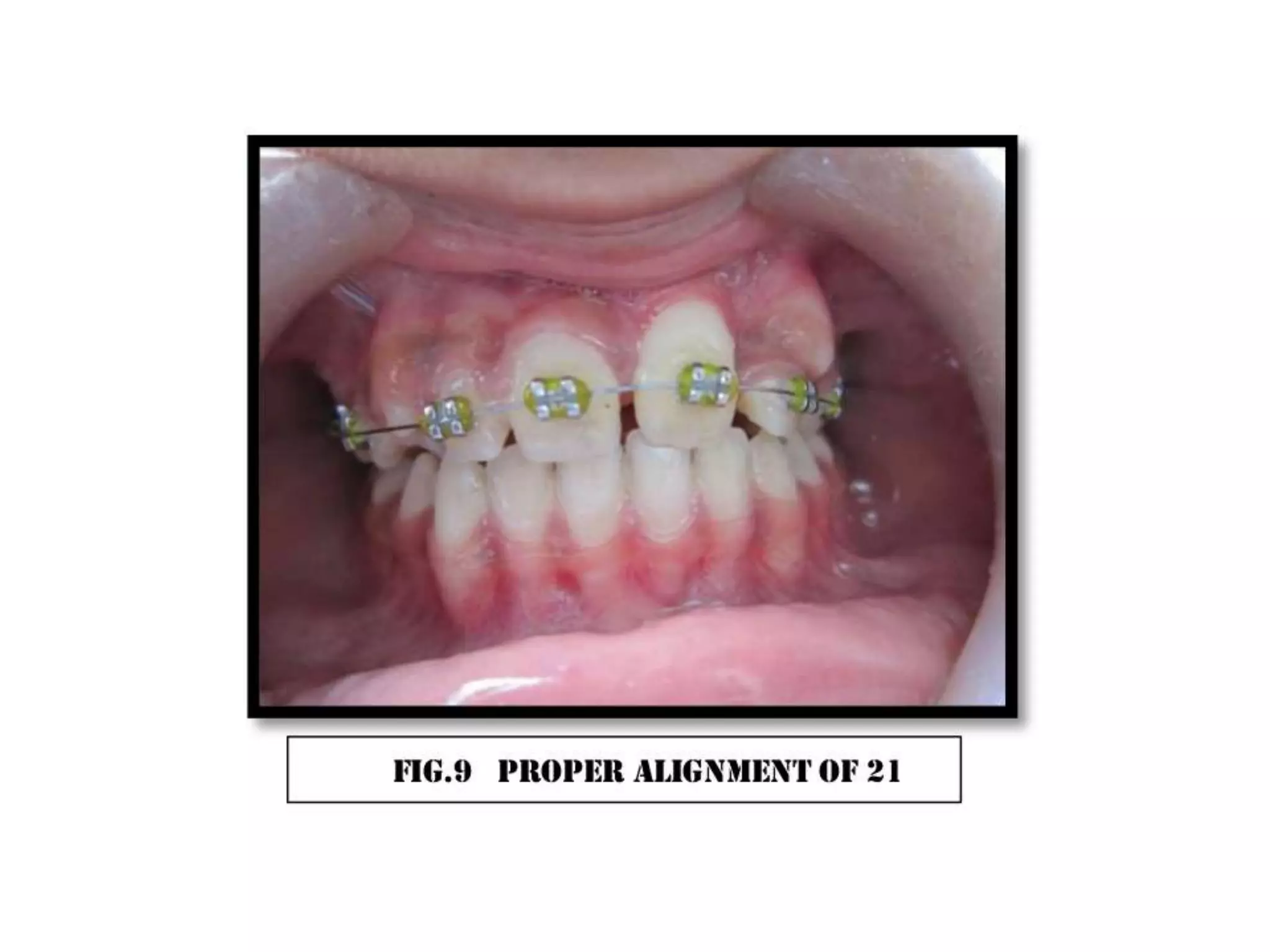 Orthodontic extrusion of impacted tooth | PPTX