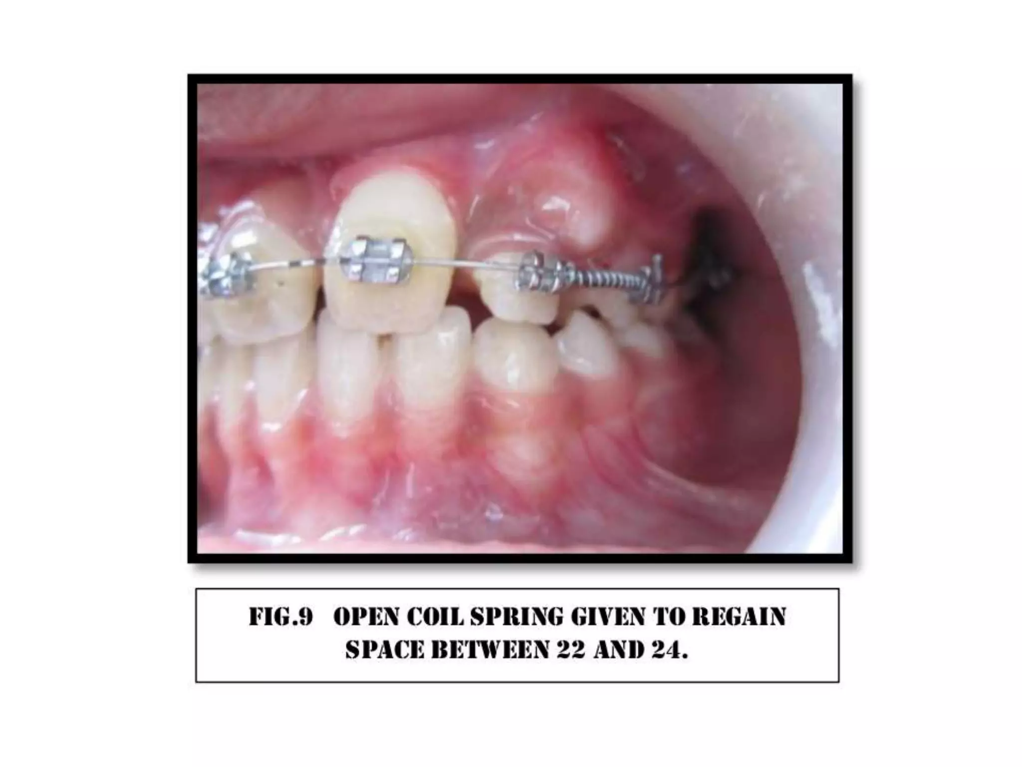 Orthodontic extrusion of impacted tooth | PPTX