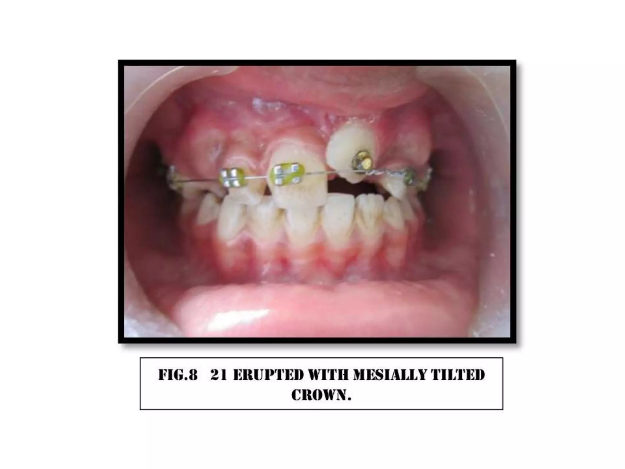 Orthodontic extrusion of impacted tooth | PPTX