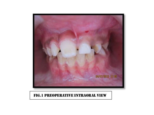 Orthodontic extrusion of impacted tooth | PPTX