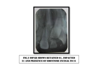 Orthodontic extrusion of impacted tooth | PPTX