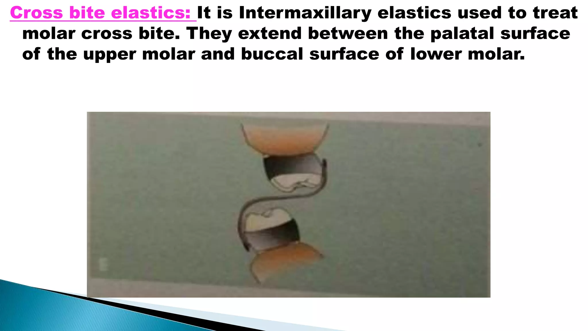 Orthodontic fixed appliances | PPTX