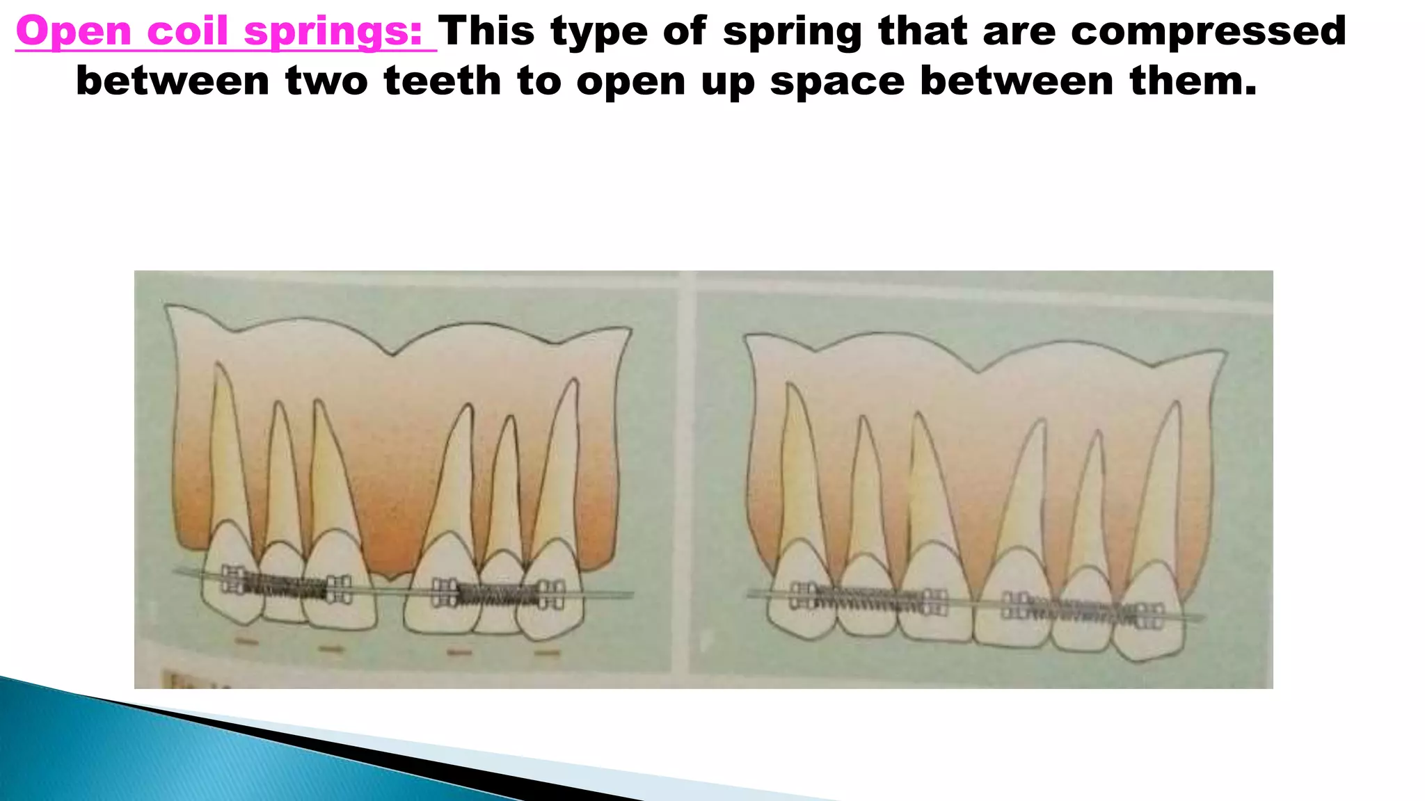 Orthodontic fixed appliances | PPTX