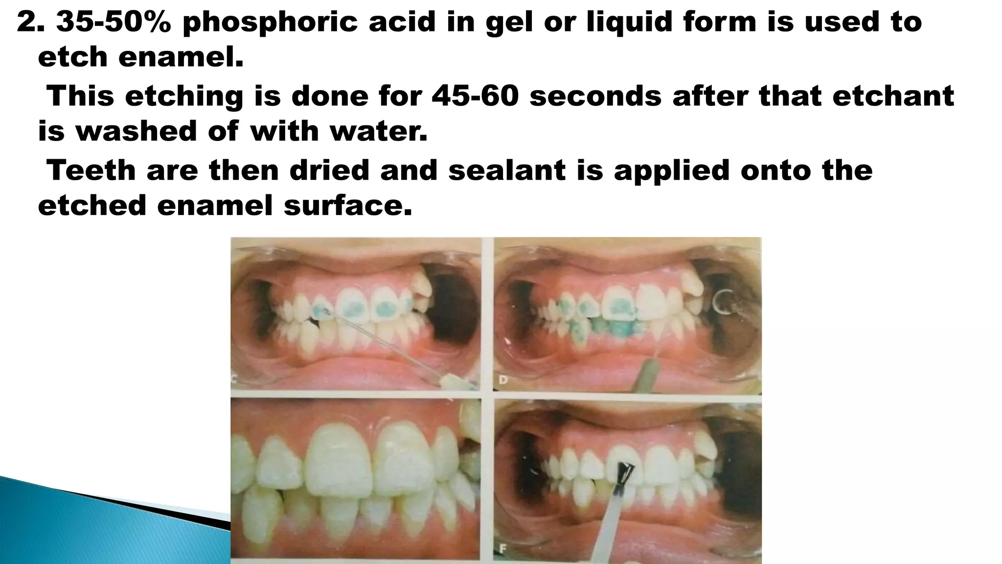 Orthodontic fixed appliances | PPTX