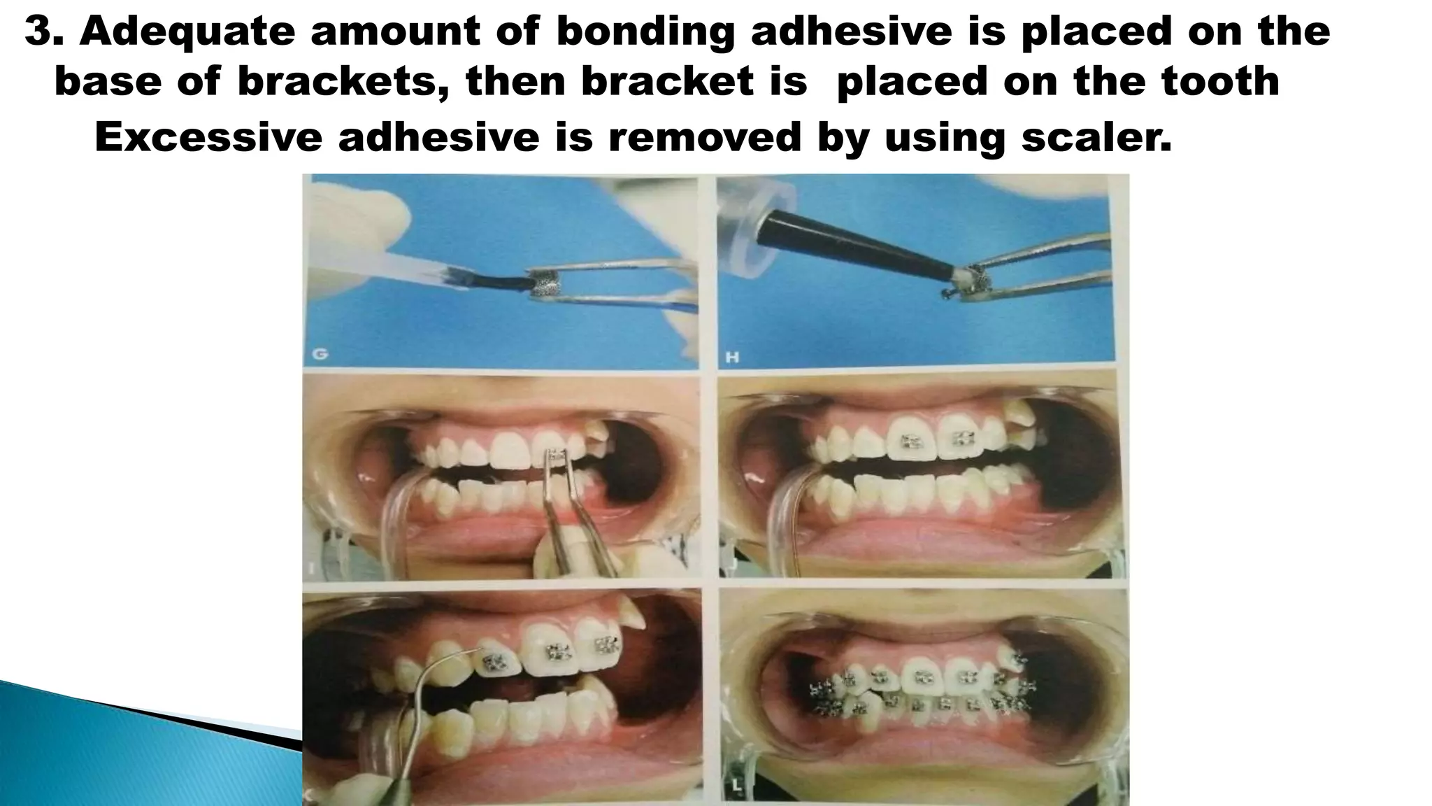 Orthodontic fixed appliances | PPTX