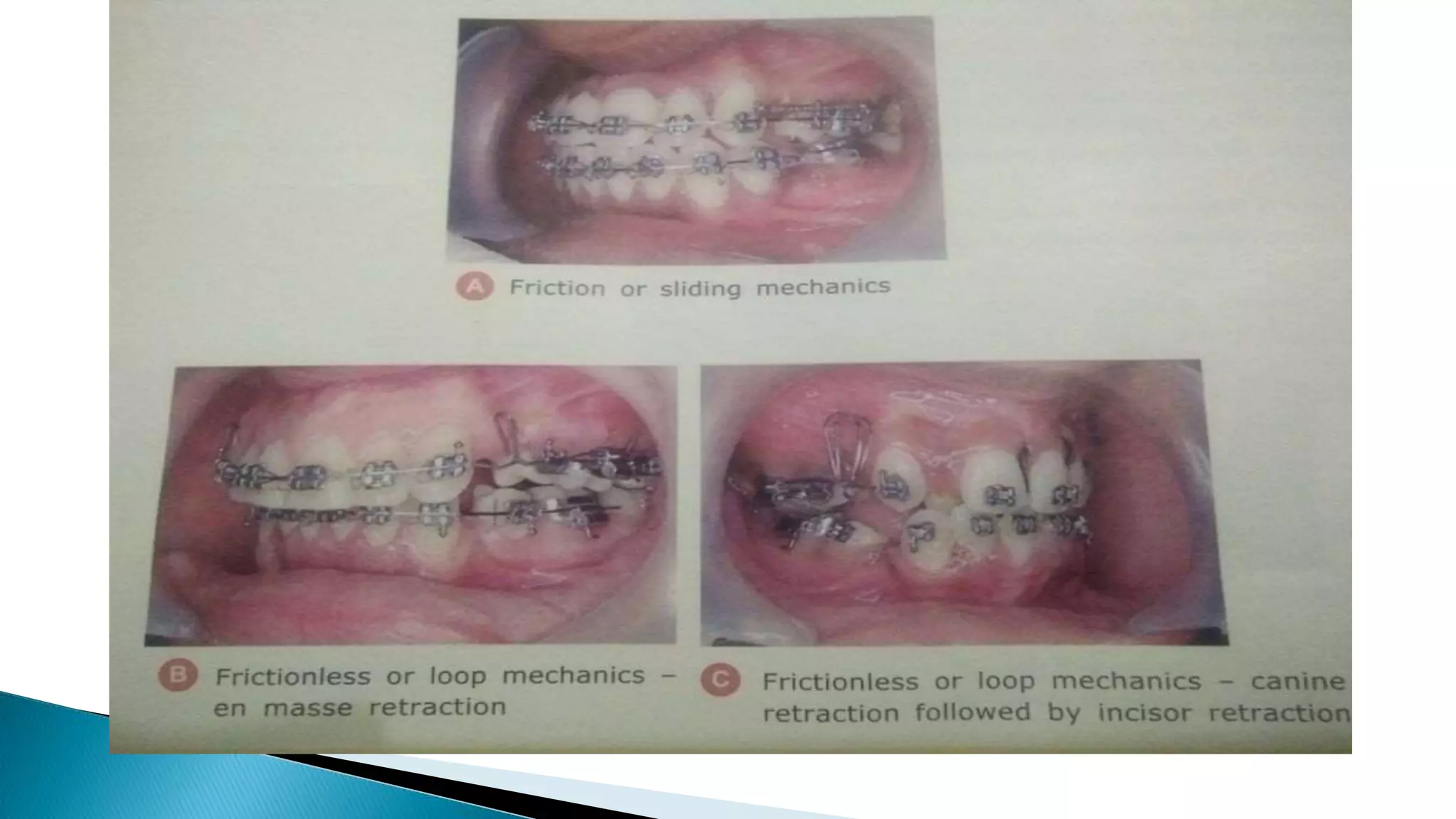 Orthodontic fixed appliances | PPTX