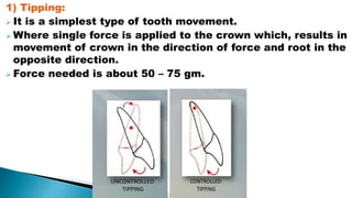 Orthodontic fixed appliances | PPTX