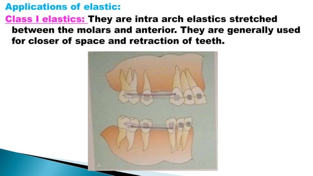 Orthodontic fixed appliances | PPTX | Dental Health | Diseases and ...