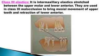 Orthodontic fixed appliances | PPTX