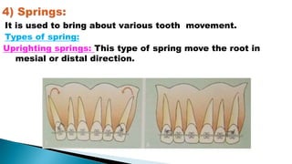 Orthodontic fixed appliances | PPTX