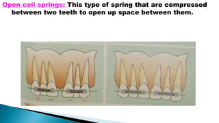 Orthodontic fixed appliances | PPTX