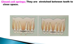 Orthodontic fixed appliances | PPTX
