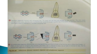 Orthodontic fixed appliances | PPTX