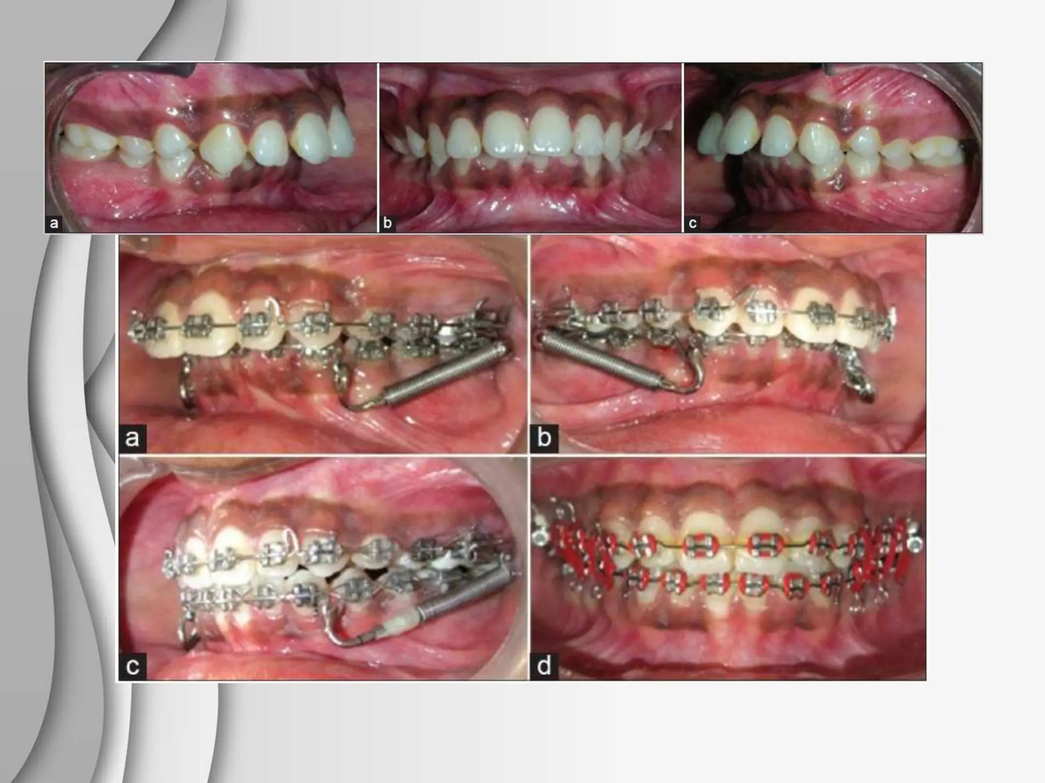 Orthodontic Forsus Fatigue Resistant Device.pptx | Oral care | Personal ...