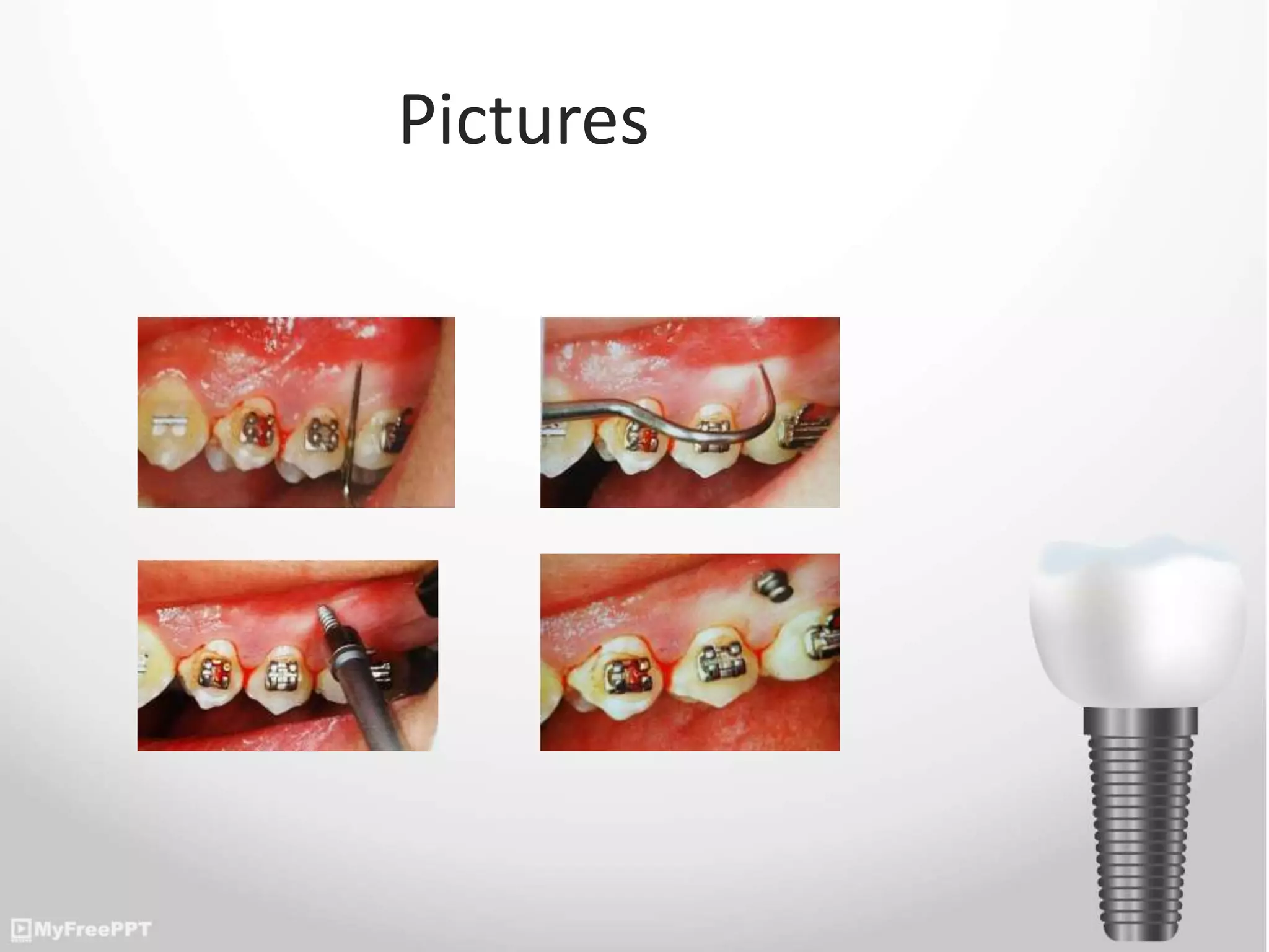 Orthodontic implant seminer | PPTX