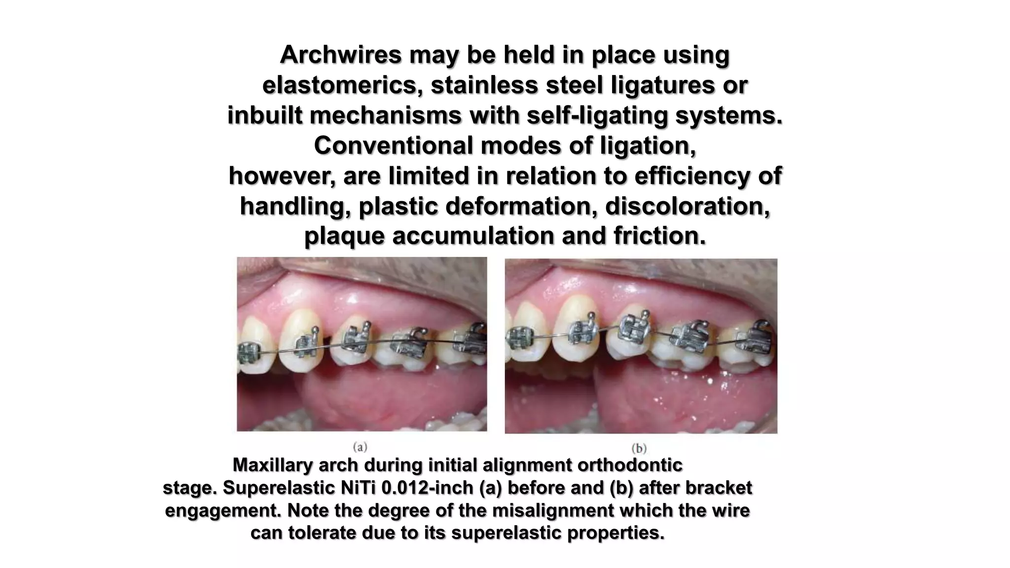 Orthodontic initial alignment of teeth | PPT