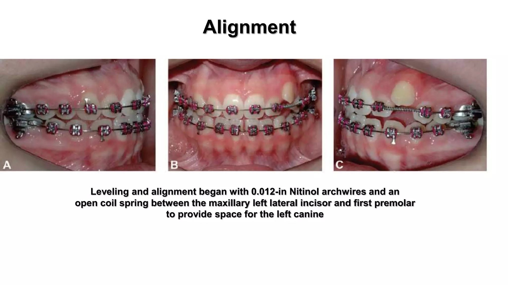 Orthodontic initial alignment of teeth | PPT