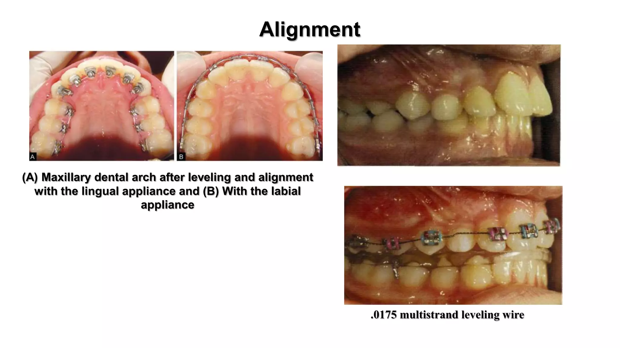 Orthodontic initial alignment of teeth | PPT