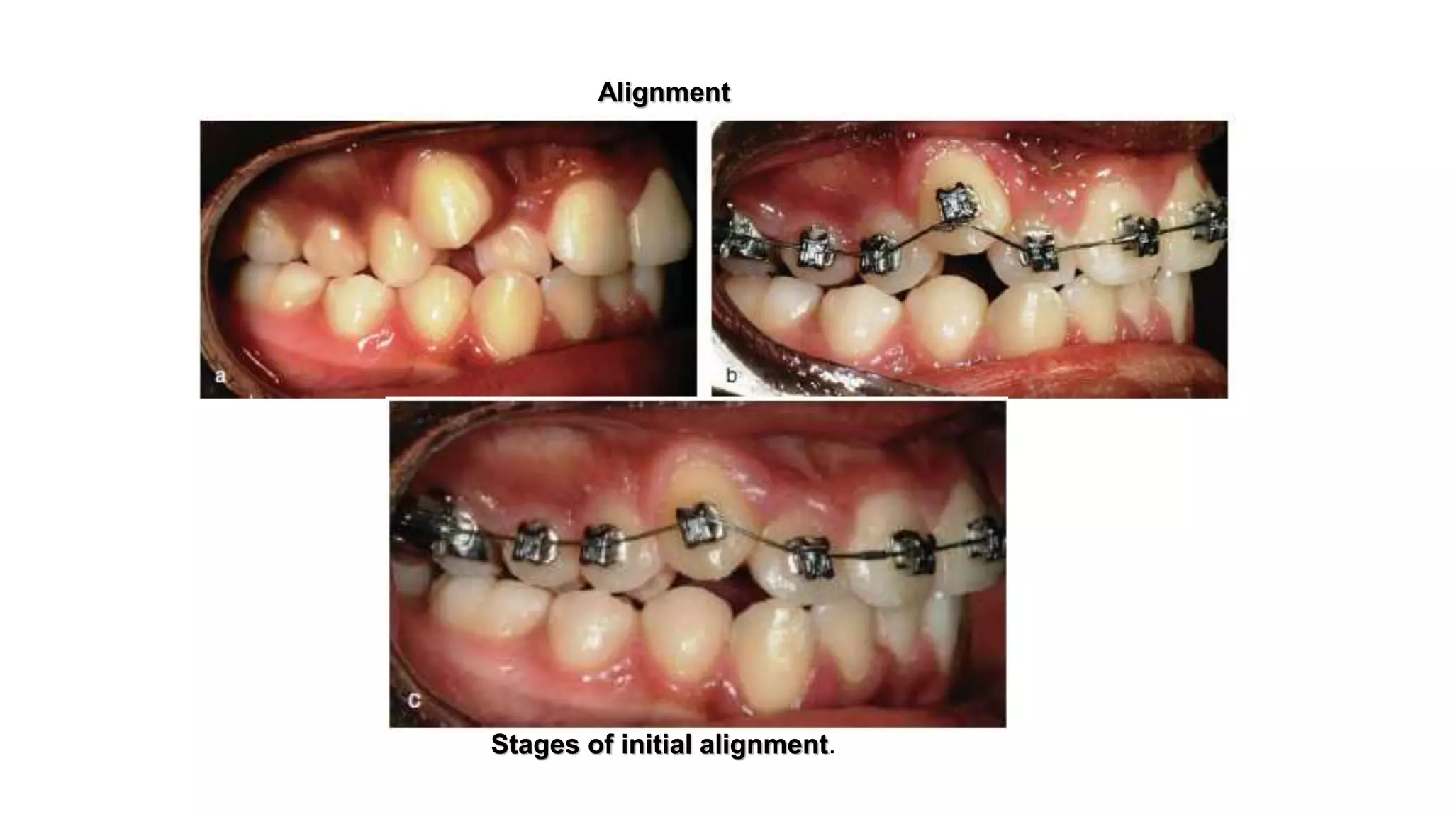 Orthodontic initial alignment of teeth | PPT