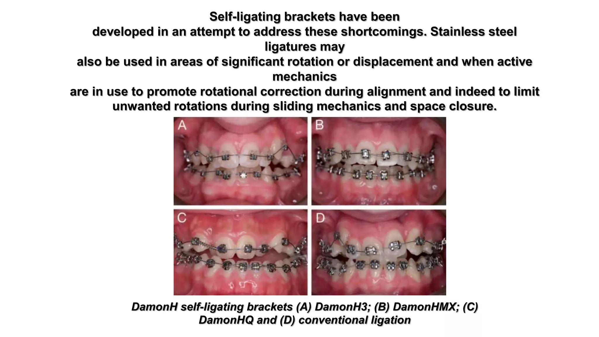 Orthodontic initial alignment of teeth | PPT