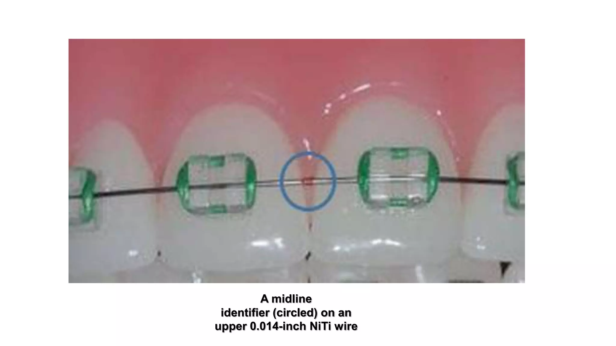 Orthodontic initial alignment of teeth | PPT