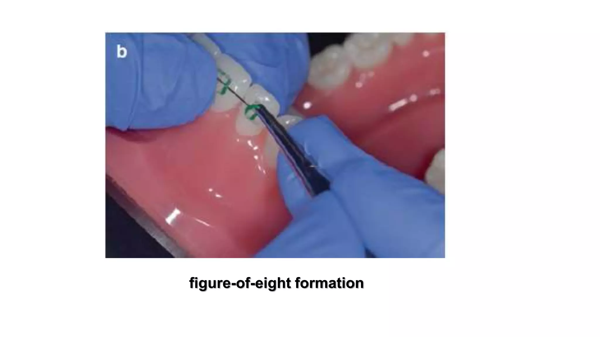 Orthodontic initial alignment of teeth | PPT