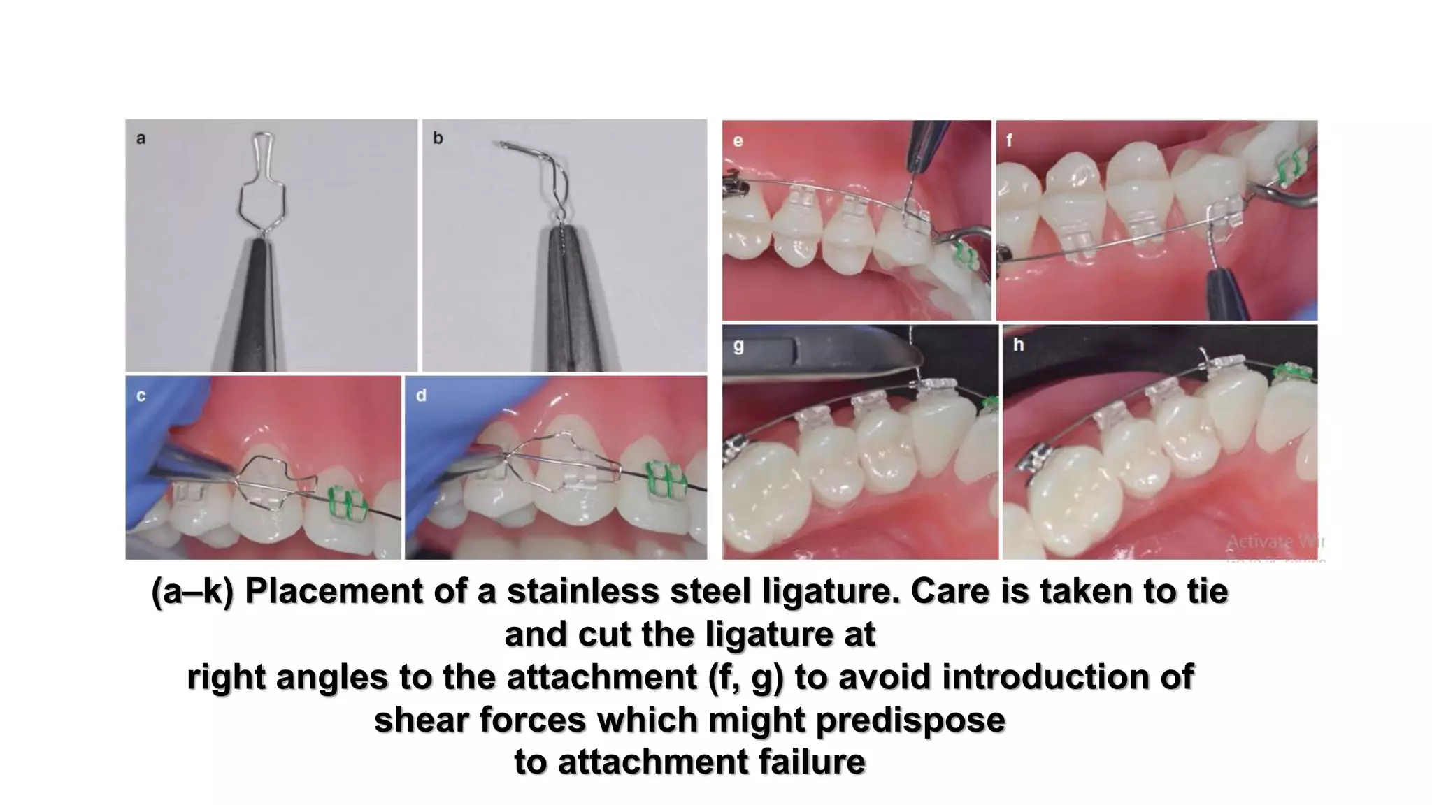 Orthodontic initial alignment of teeth | PPT