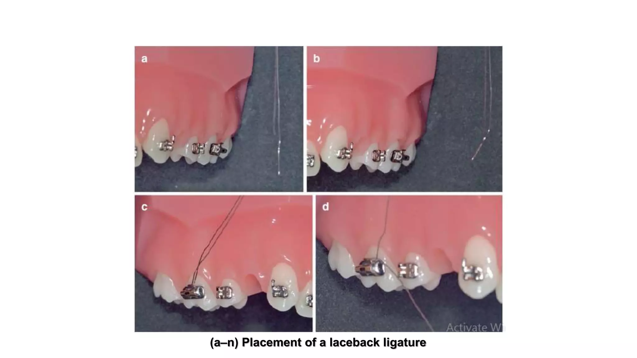 Orthodontic initial alignment of teeth | PPT