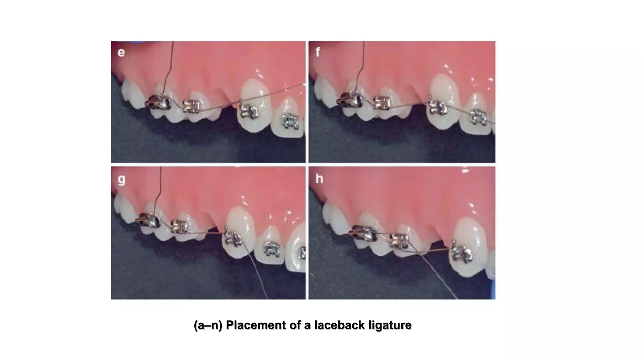 Orthodontic initial alignment of teeth | PPT