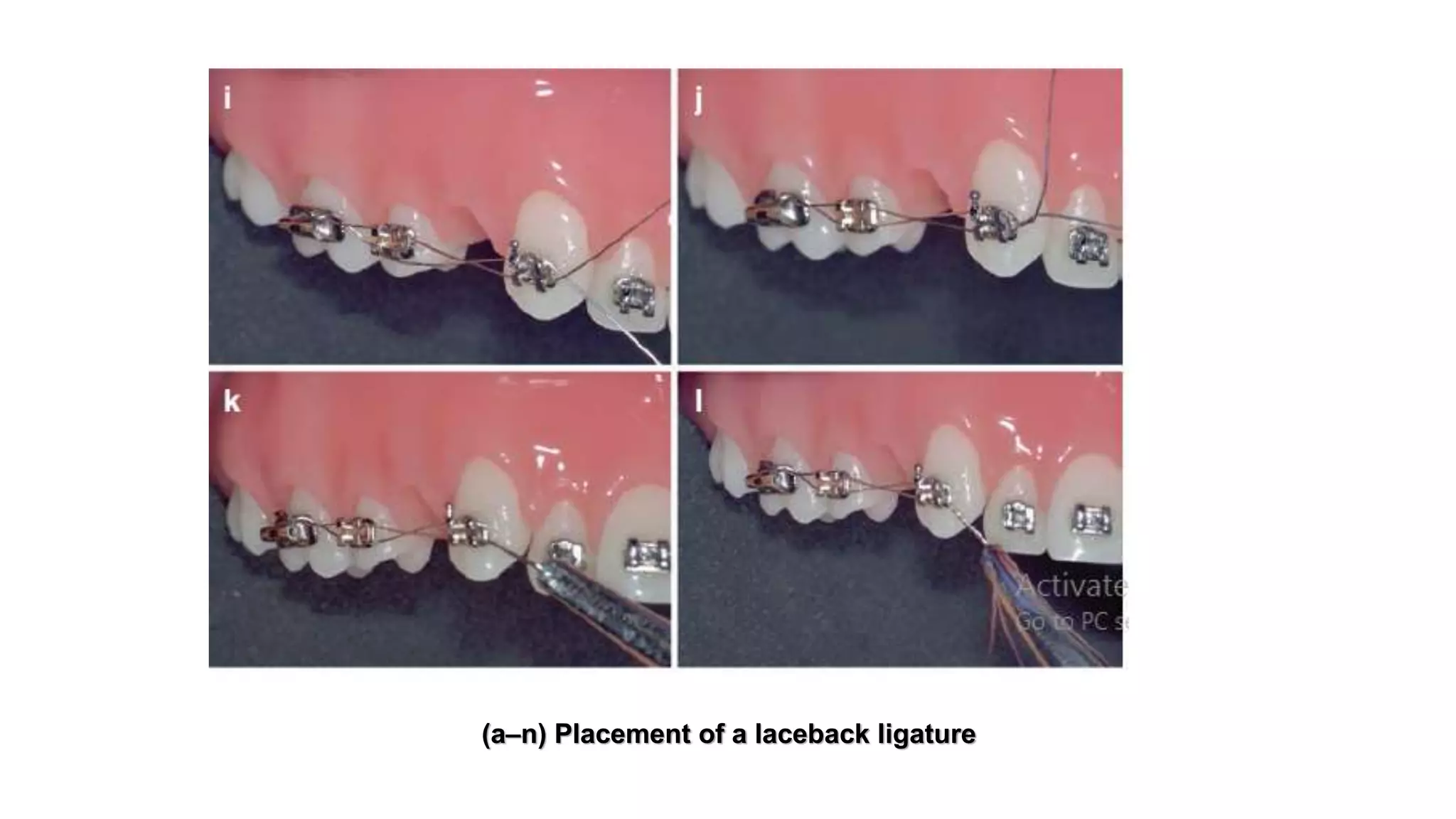 Orthodontic initial alignment of teeth | PPT